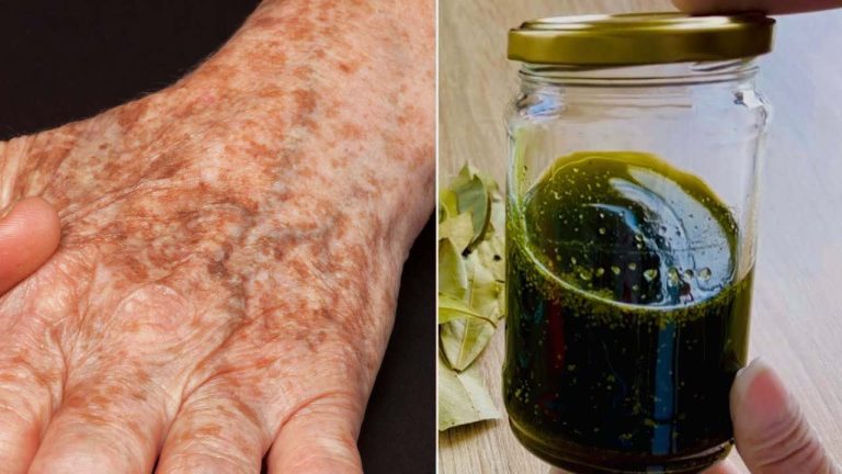 Macchie sulle mani, solo con questo liquido spariranno nel giro di ...