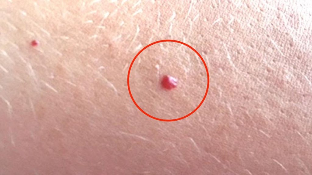 Cosa sono questi puntini rossi che spesso abbiamo sulla pelle? Tutta la ...