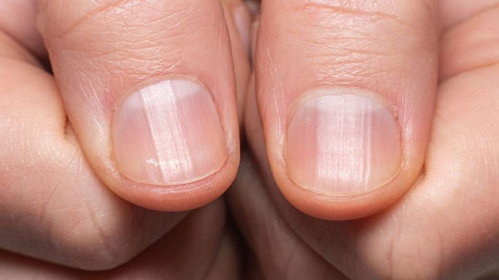 Perché le unghie diventano striate? La motivazione è nota a pochi: la ...